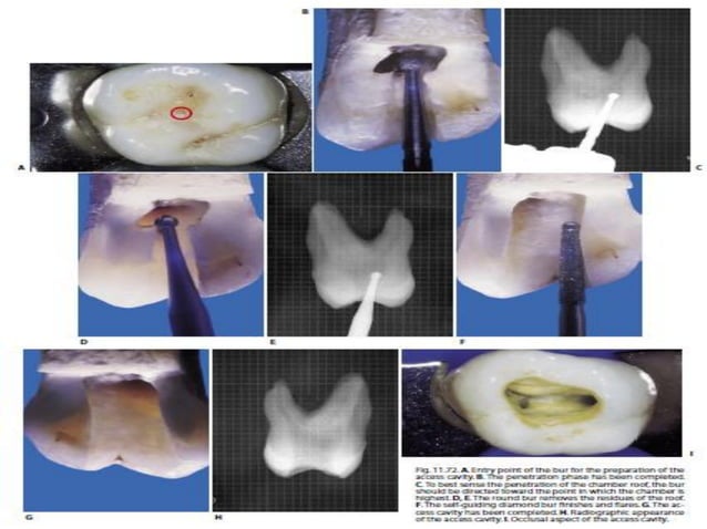 Access opening of molar teeth | PDF