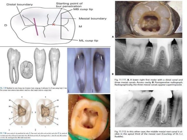 Access opening of molar teeth | PDF