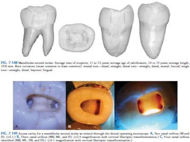 Access opening of molar teeth | PDF