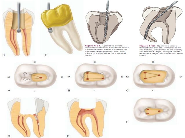 Access opening of molar teeth | PDF