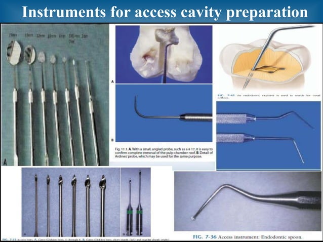Access opening of molar teeth | PDF