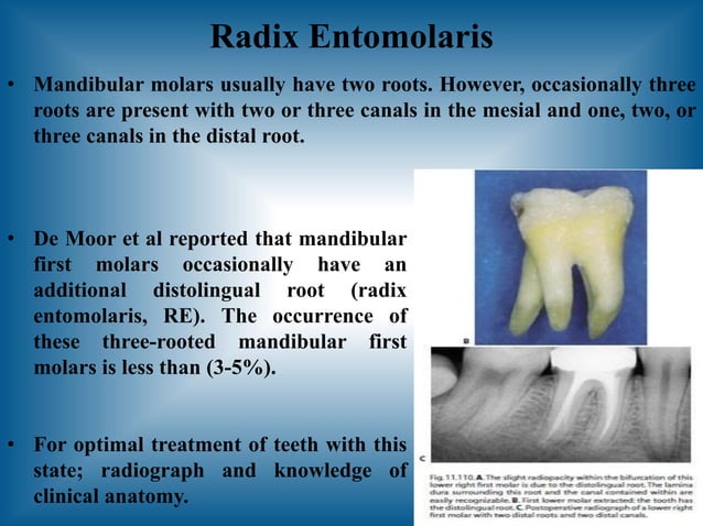 Access opening of molar teeth | PDF