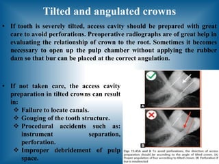 Access opening of molar teeth | PDF