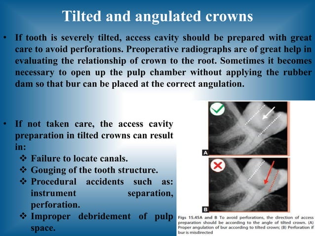 Access opening of molar teeth | PDF