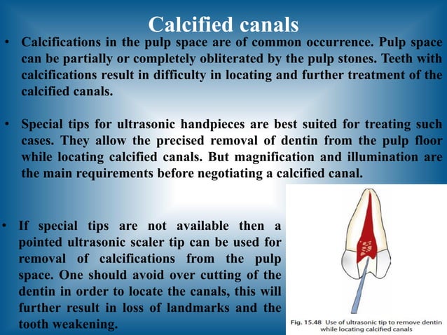 Access opening of molar teeth | PDF