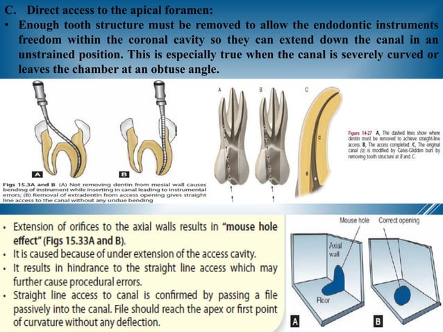 Access opening of molar teeth | PDF