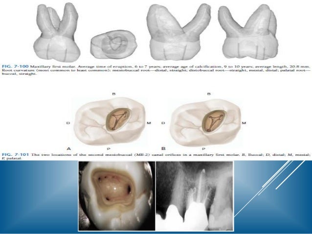 Access opening of molar teeth