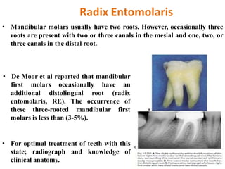 access opening of molar teeth-shivangi.pptx