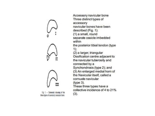 Accessory navicular | PPTX