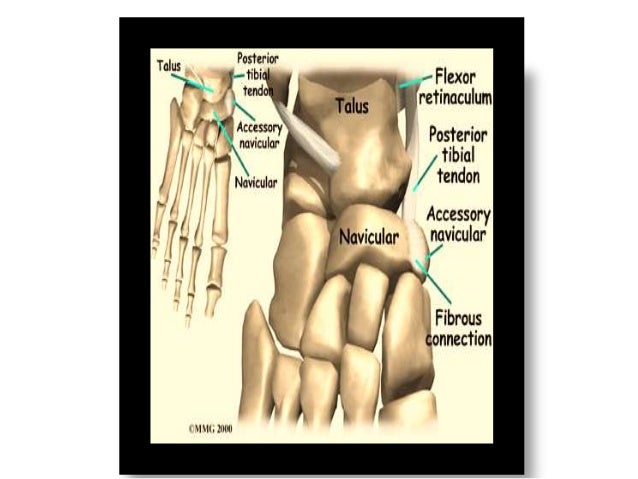 Accessory Navicular Bone