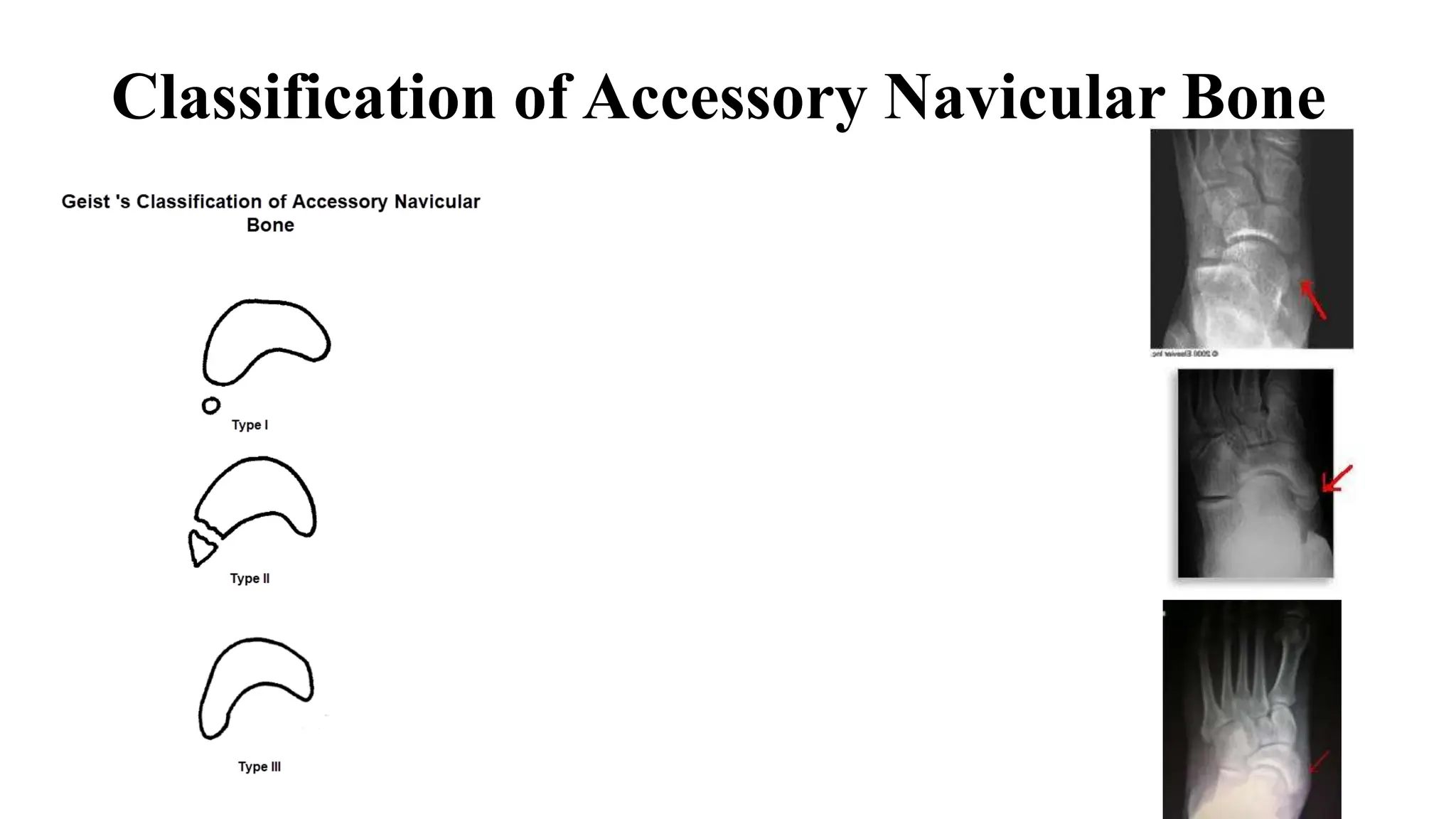 Accessory Navicular Bone.pptx