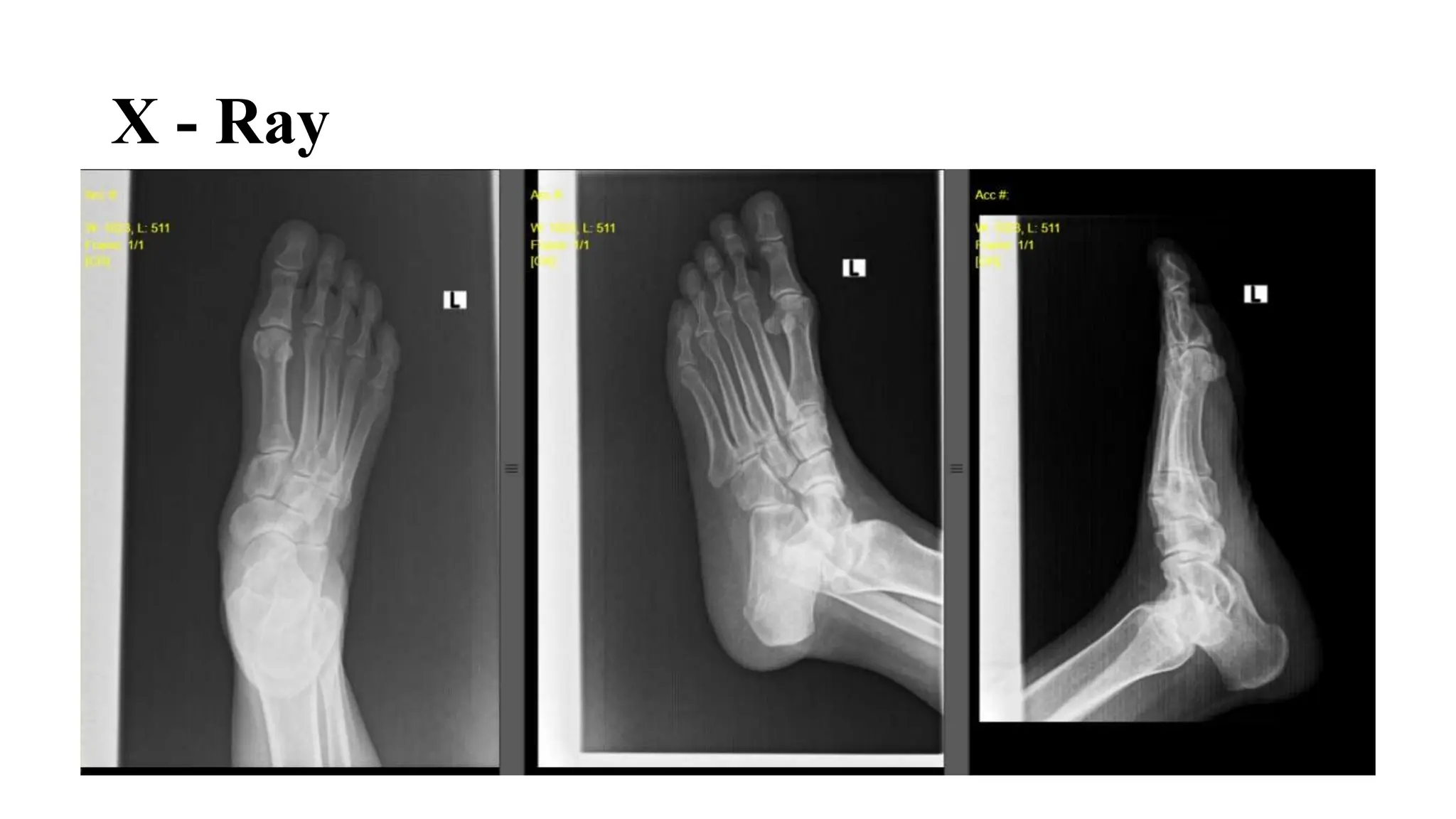Accessory Navicular Bone.pptx