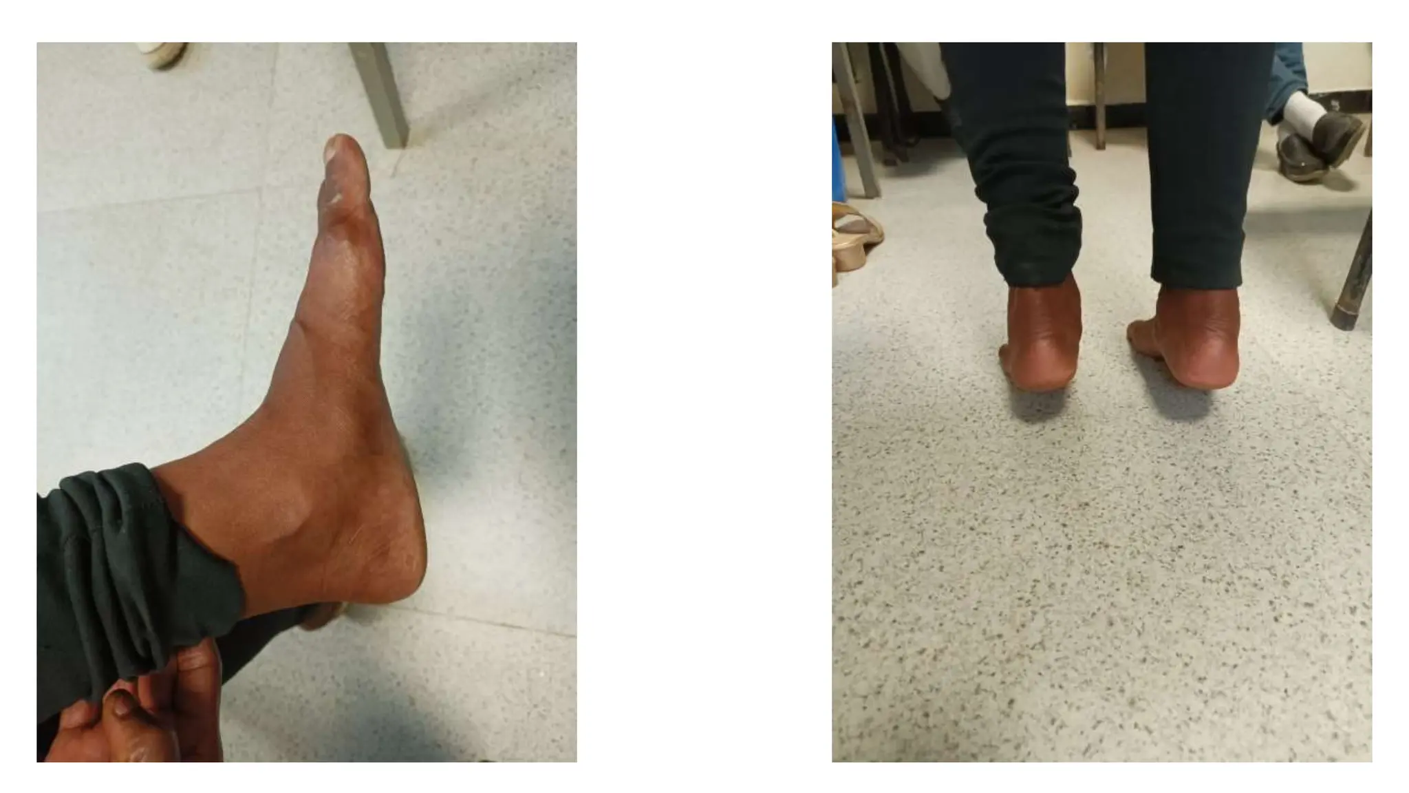 Accessory Navicular Bone.pptx
