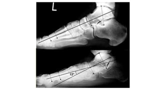 Accessory Navicular Bone.pptx