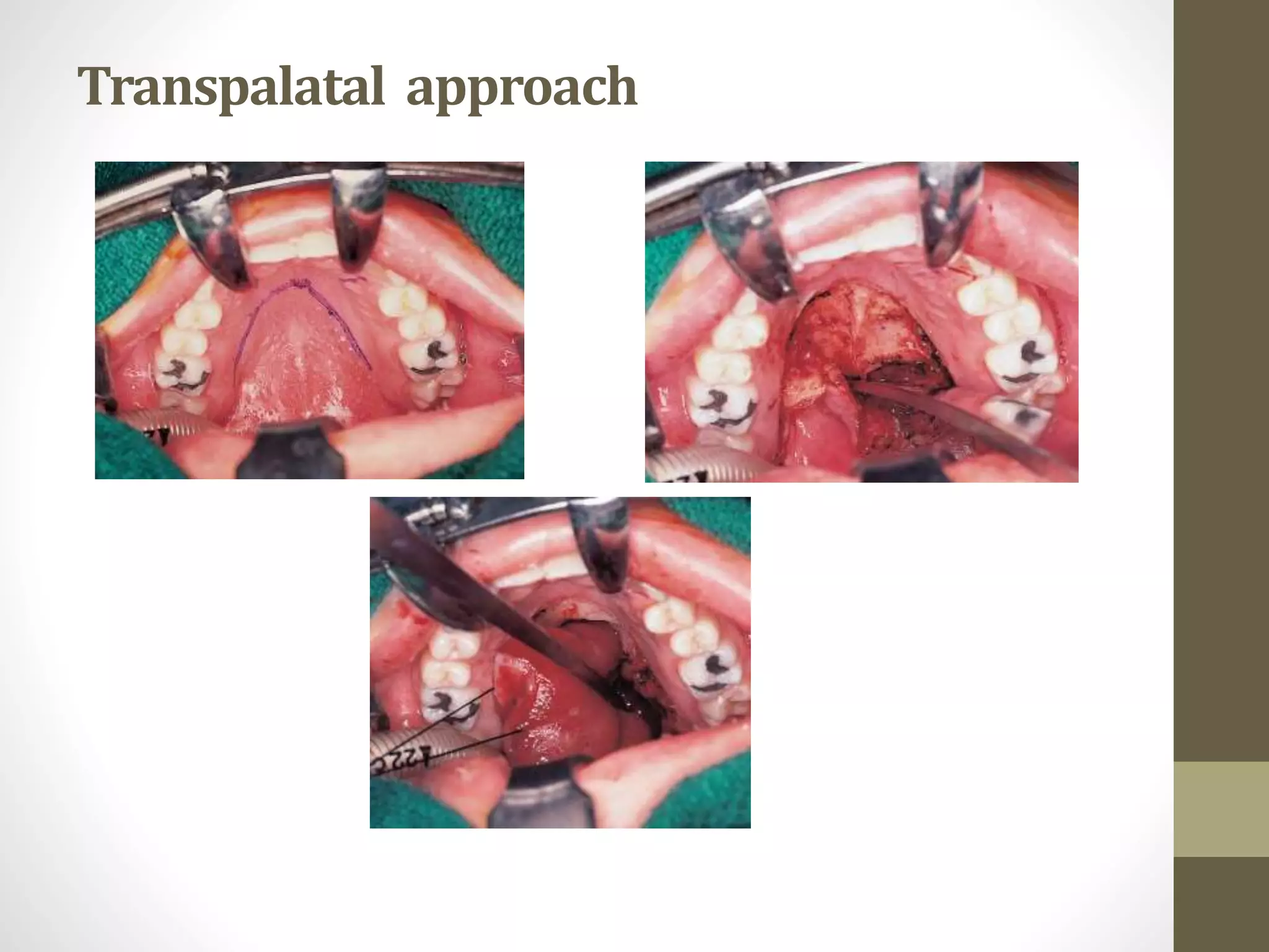 Access osteotomy | PPTX