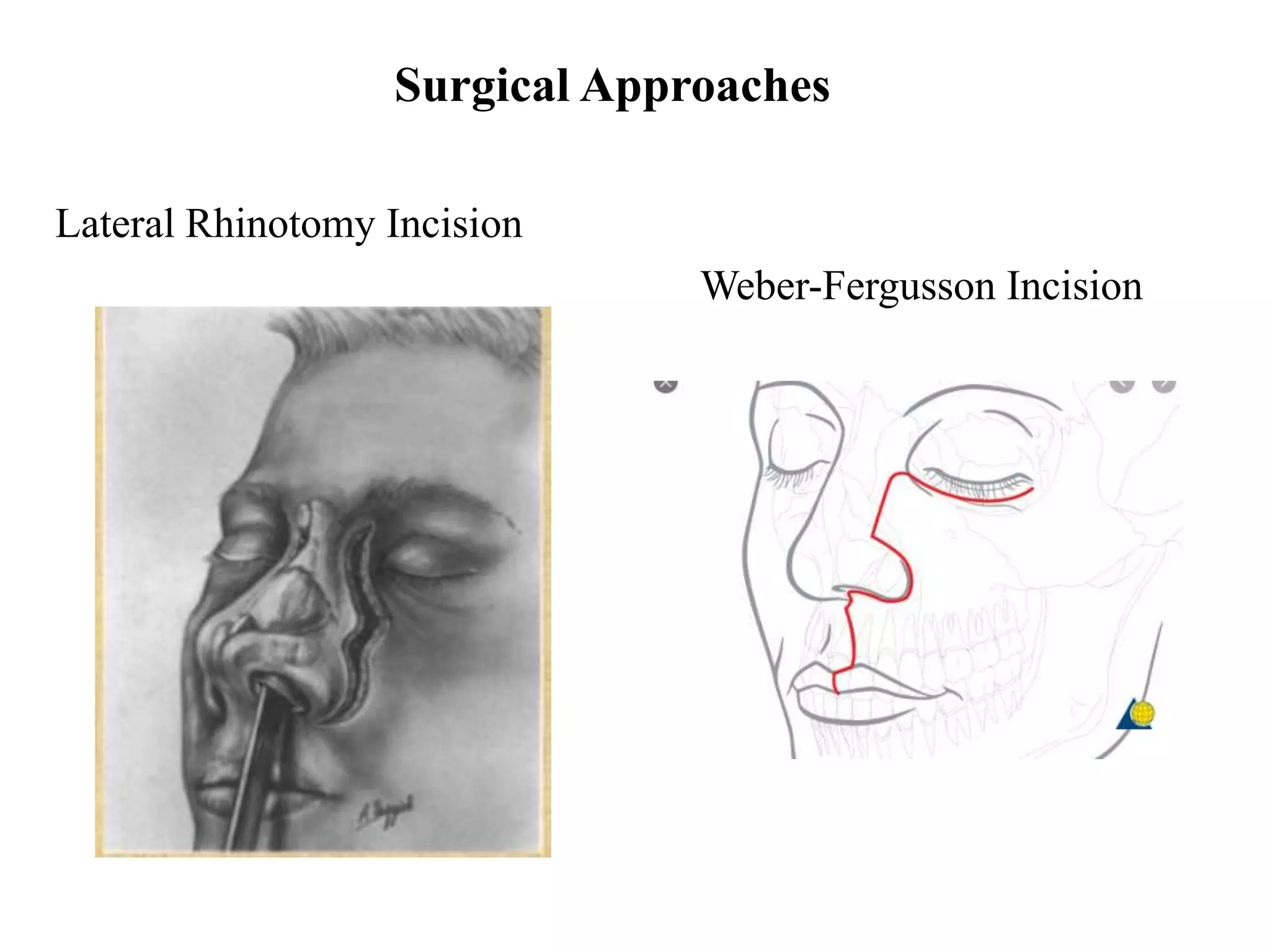 Access osteotomies in oral & cranio-maxillofacial surgery | PPTX