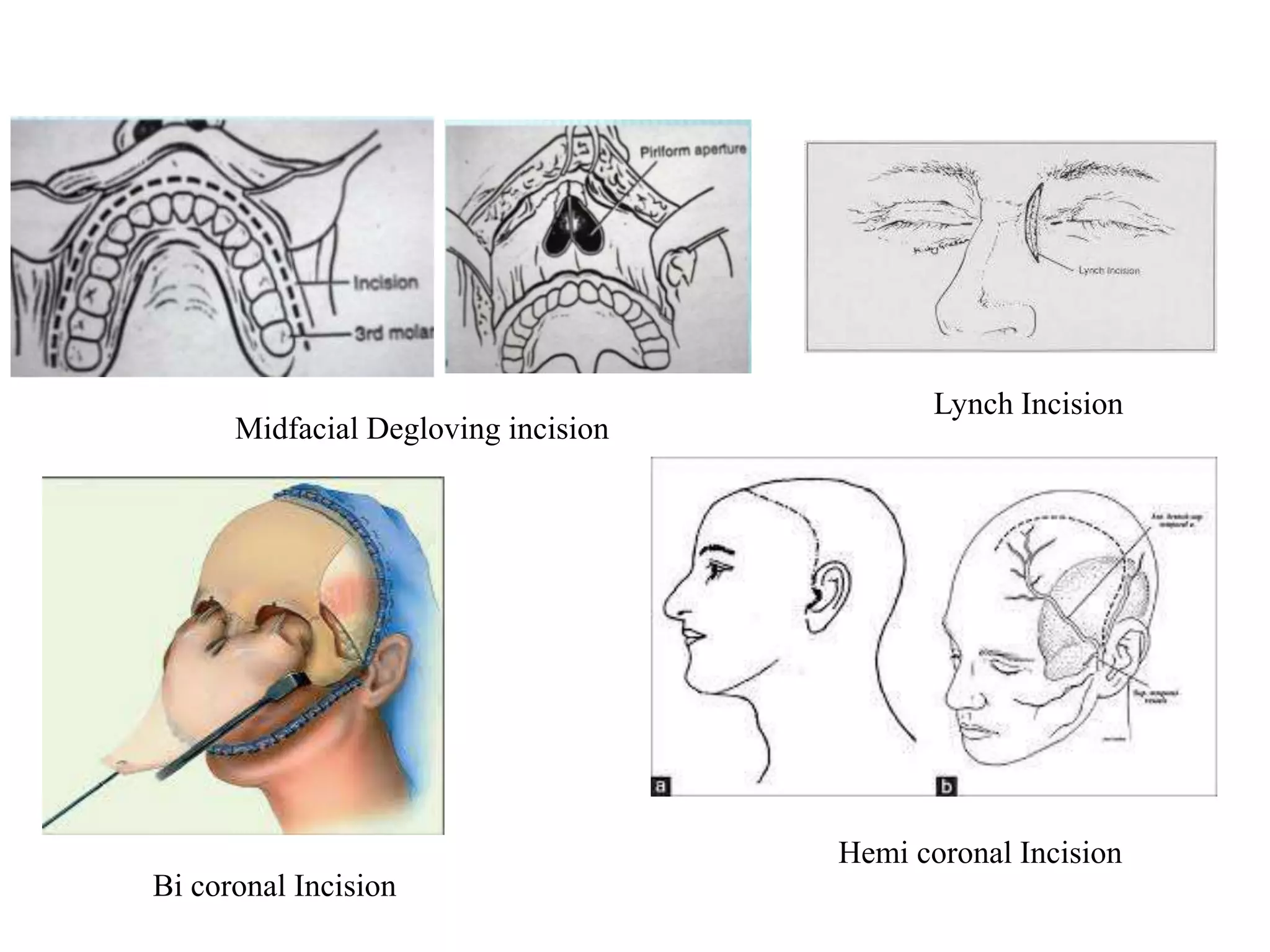 Access osteotomies in oral & cranio-maxillofacial surgery | PPTX