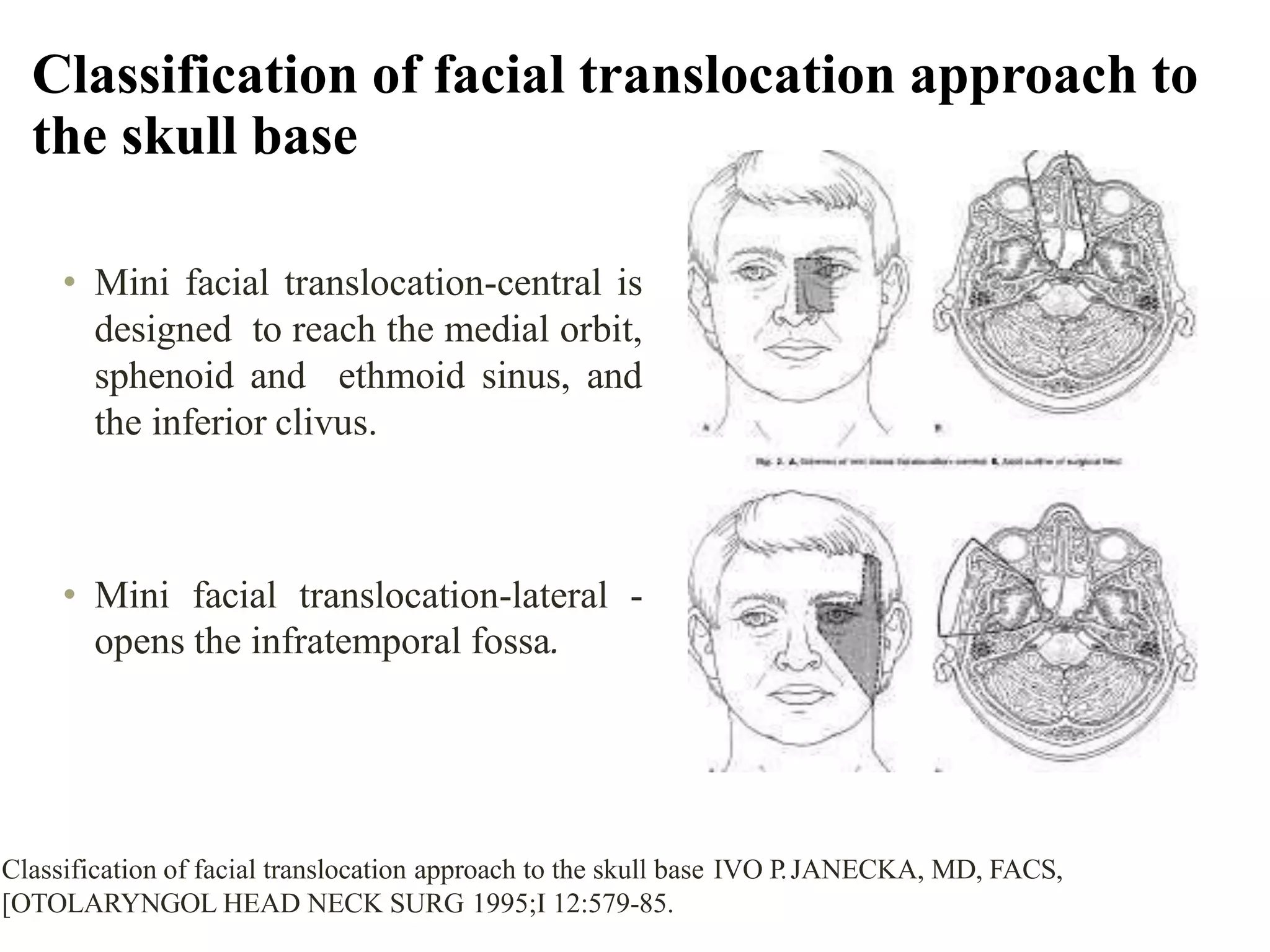 Access osteotomies in oral & cranio-maxillofacial surgery | PPTX