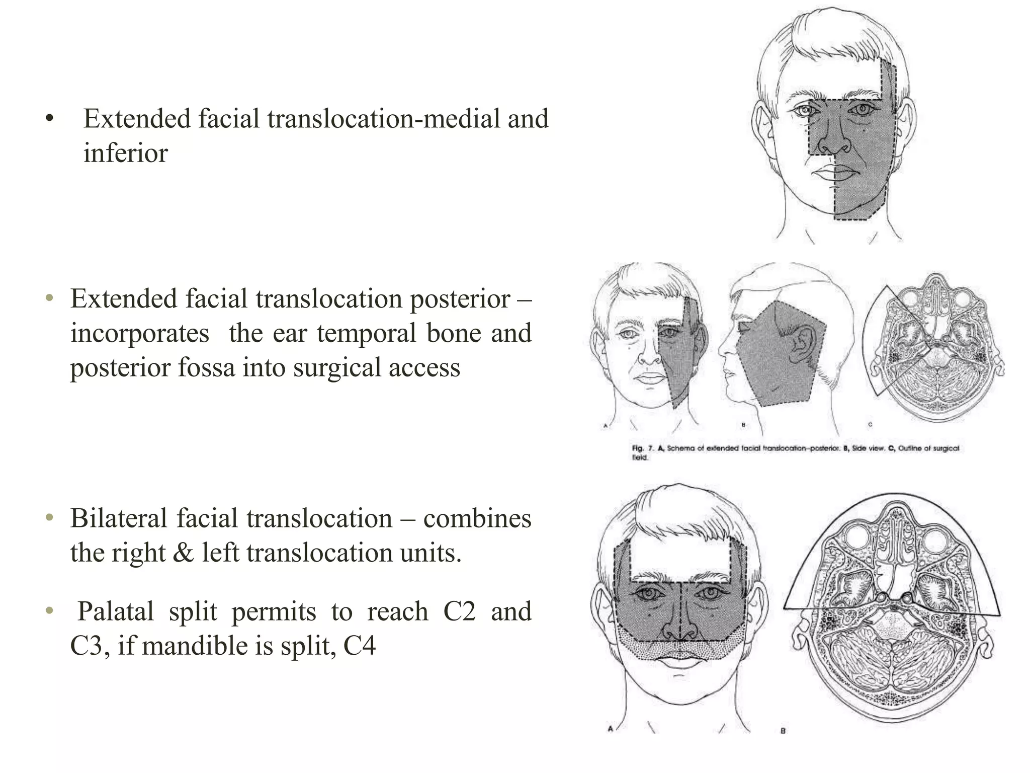 Access osteotomies in oral & cranio-maxillofacial surgery | PPTX