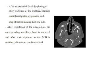 Access osteotomies in oral & cranio-maxillofacial surgery | PPTX