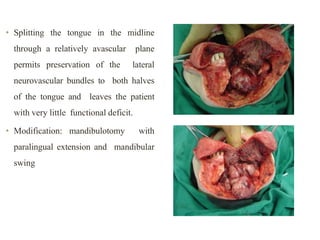 Access osteotomies in oral & cranio-maxillofacial surgery | PPTX