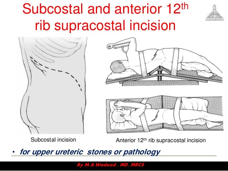 Access to urinary system v2