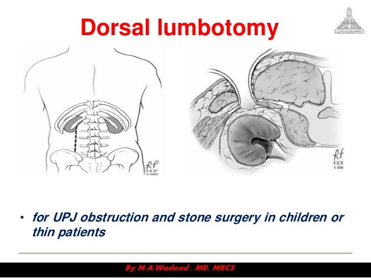 Access to urinary system v2