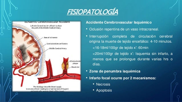 Accidente Cerebro Vascular (ACV)