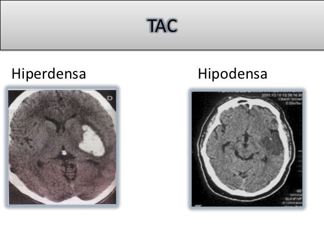 Accidente cerebro vascular isquémico 1