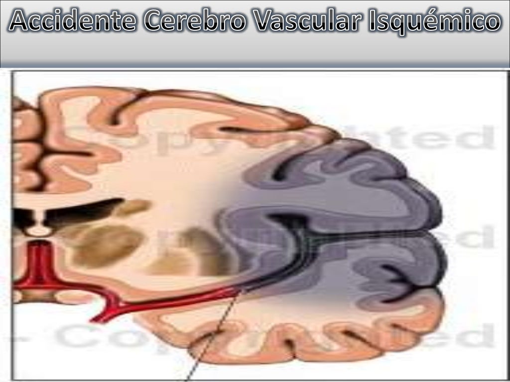 Accidente cerebro vascular isquémico 1