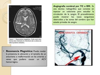 Accidente cerebrovascular presentacion | PDF