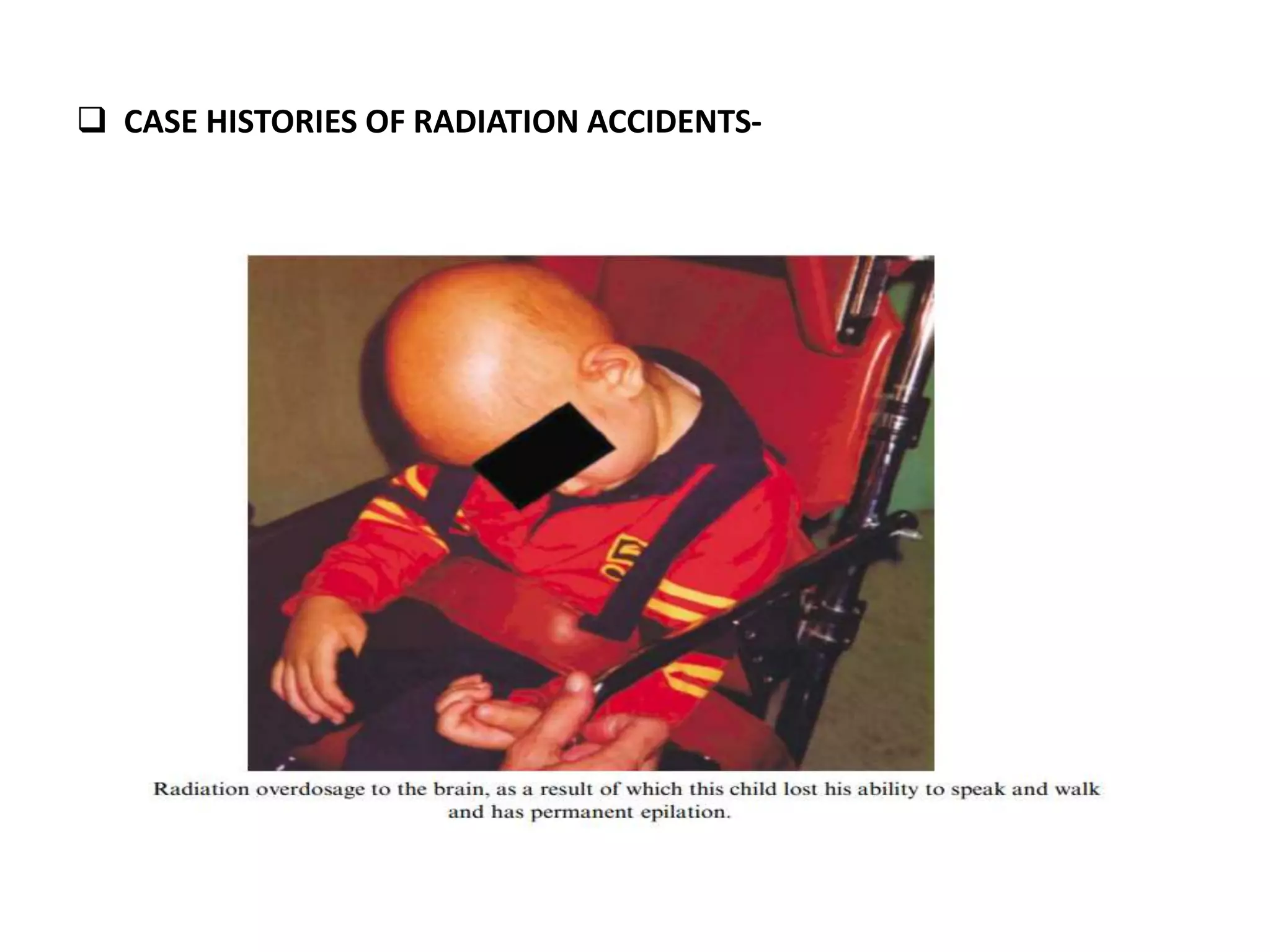 Accidents in Radiotherapy | PPTX