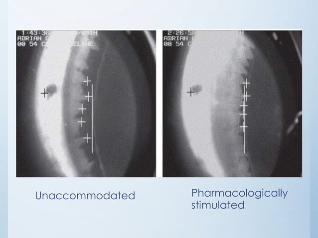 Accommodation of eye | PPTX | Eye and Vision Conditions | Diseases and ...