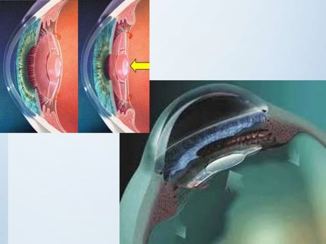 Accommodation of eye | PPTX | Eye and Vision Conditions | Diseases and ...