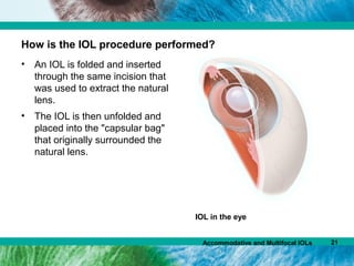 Accommodative and multifocal intraocular lenses | ODP