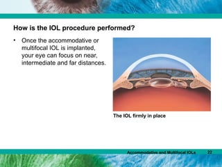 Accommodative and multifocal intraocular lenses | ODP