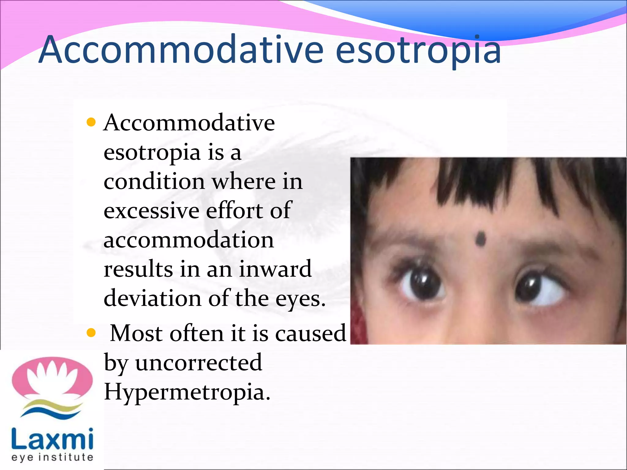 Accommodative esotropia | PPTX