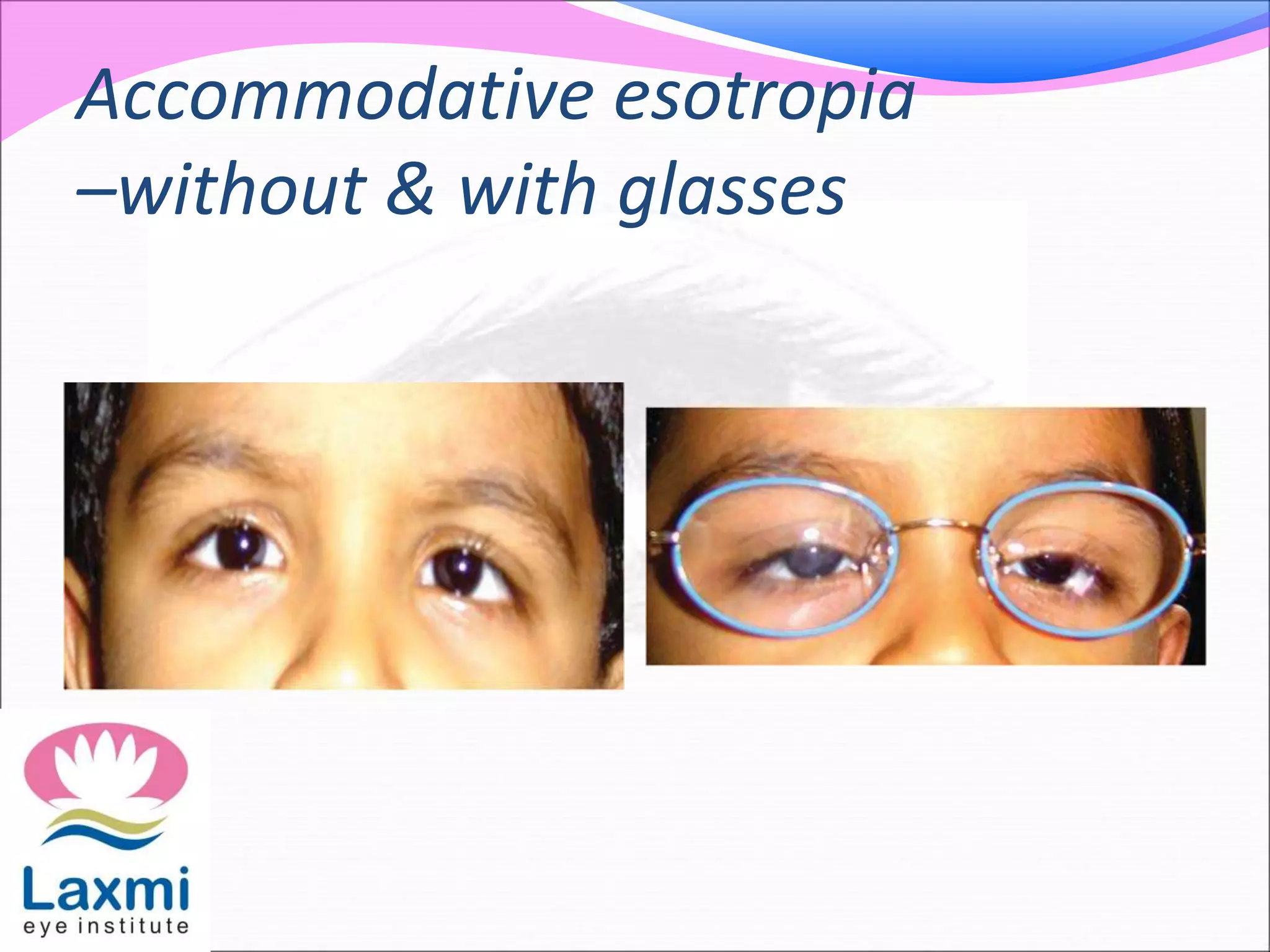 Accommodative esotropia | PPTX