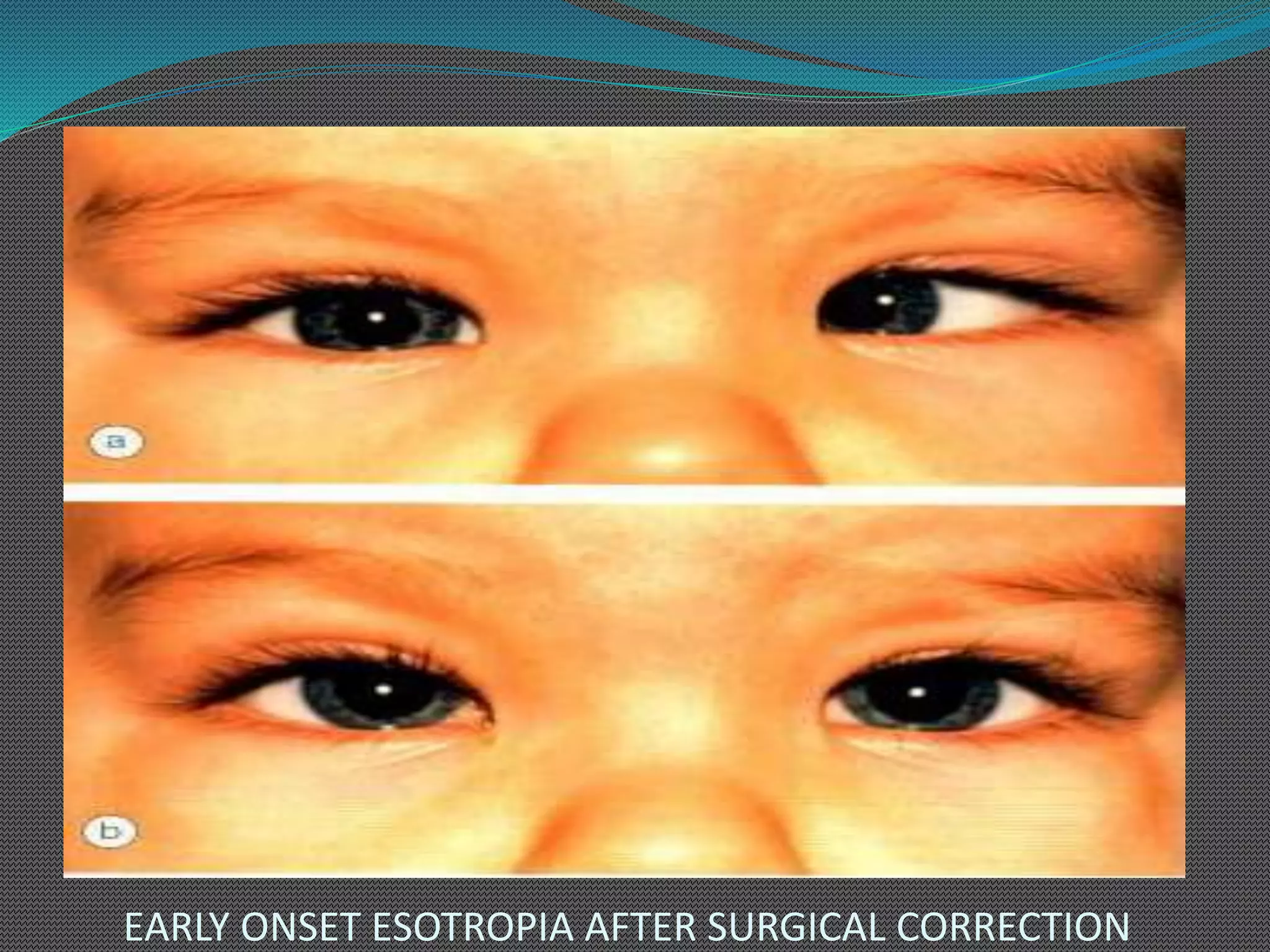 Accommodative esotropia | PPTX