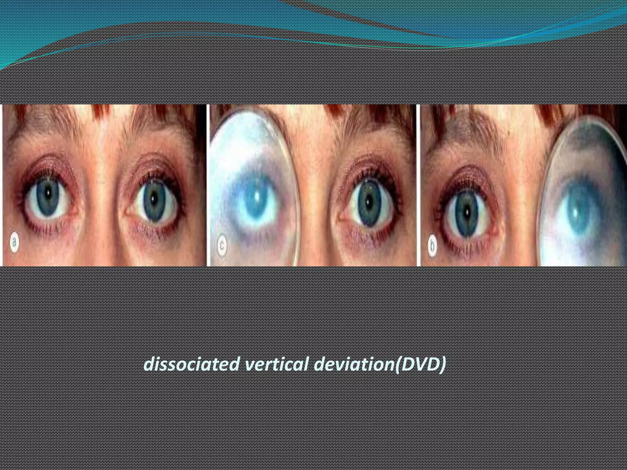 Accommodative esotropia | PPTX