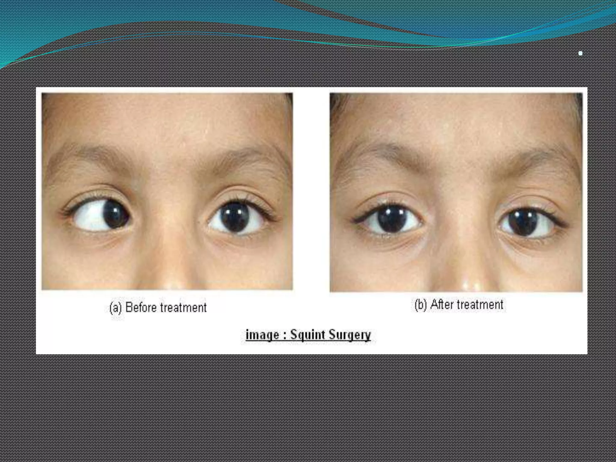 Accommodative esotropia | PPTX