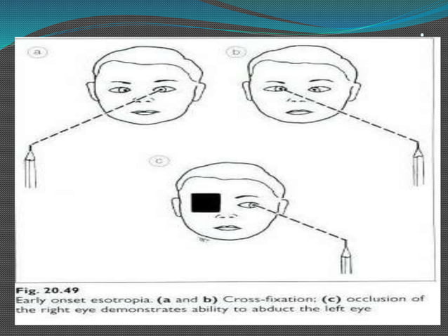 Accommodative esotropia | PPTX | Eye and Vision Conditions | Diseases ...