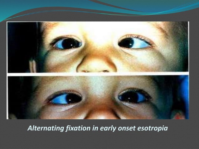 Accommodative esotropia | PPTX | Eye and Vision Conditions | Diseases and Conditions