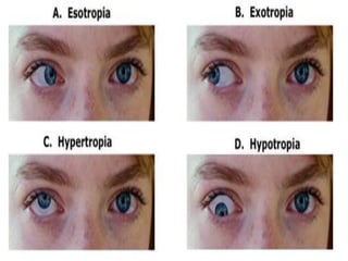 Accommodative esotropia | PPTX