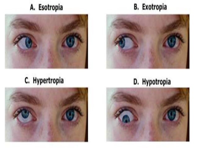 Accommodative esotropia | PPTX | Eye and Vision Conditions | Diseases ...