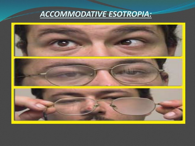 Accommodative esotropia | PPTX | Eye and Vision Conditions | Diseases and Conditions