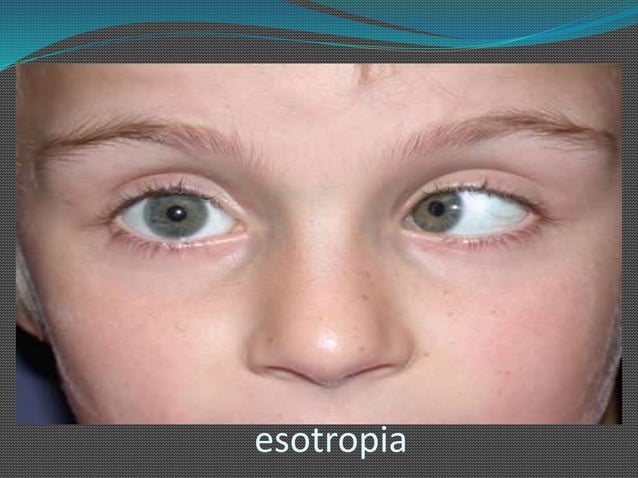 Accommodative esotropia | PPTX | Eye and Vision Conditions | Diseases ...