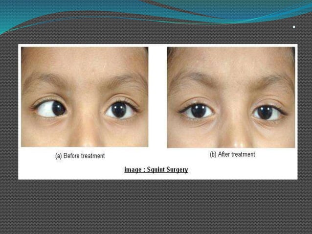 Accommodative esotropia | PPTX | Eye and Vision Conditions | Diseases ...