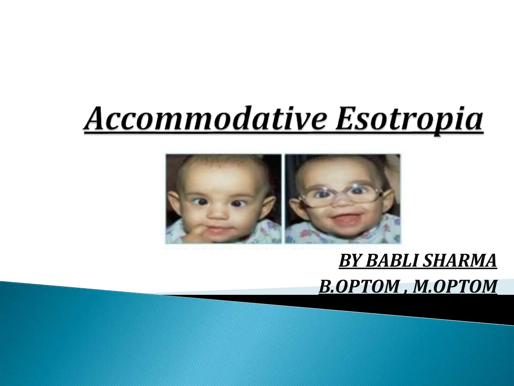 ACCOMMODATIVE ESOTROPIA.pptx............ | PPTX