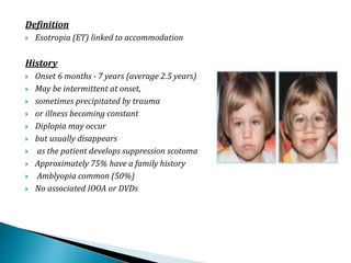 ACCOMMODATIVE ESOTROPIA.pptx............ | PPTX